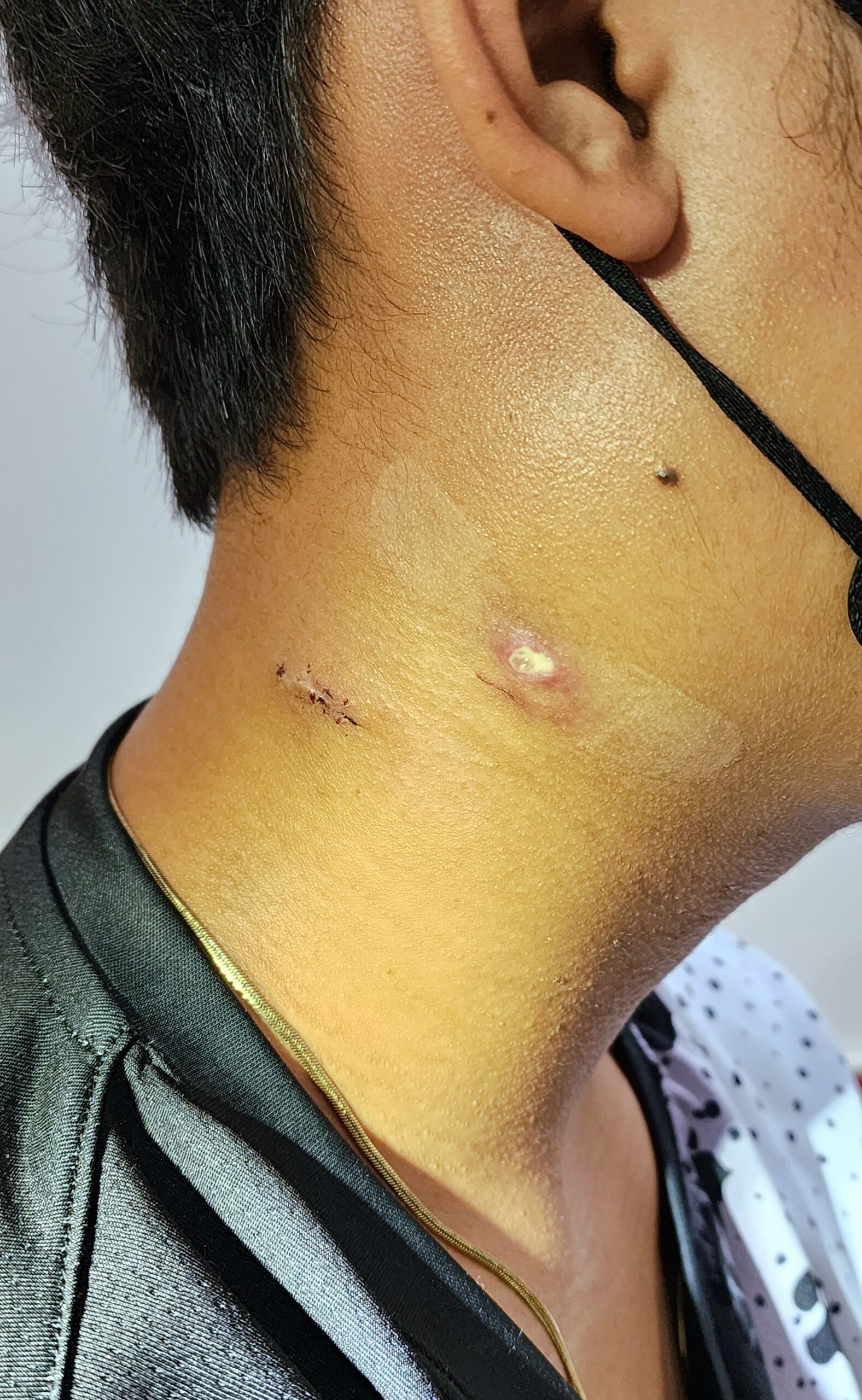 TB of the Neck Lymph Nodes - Dr. Ruth - Otolaryngology