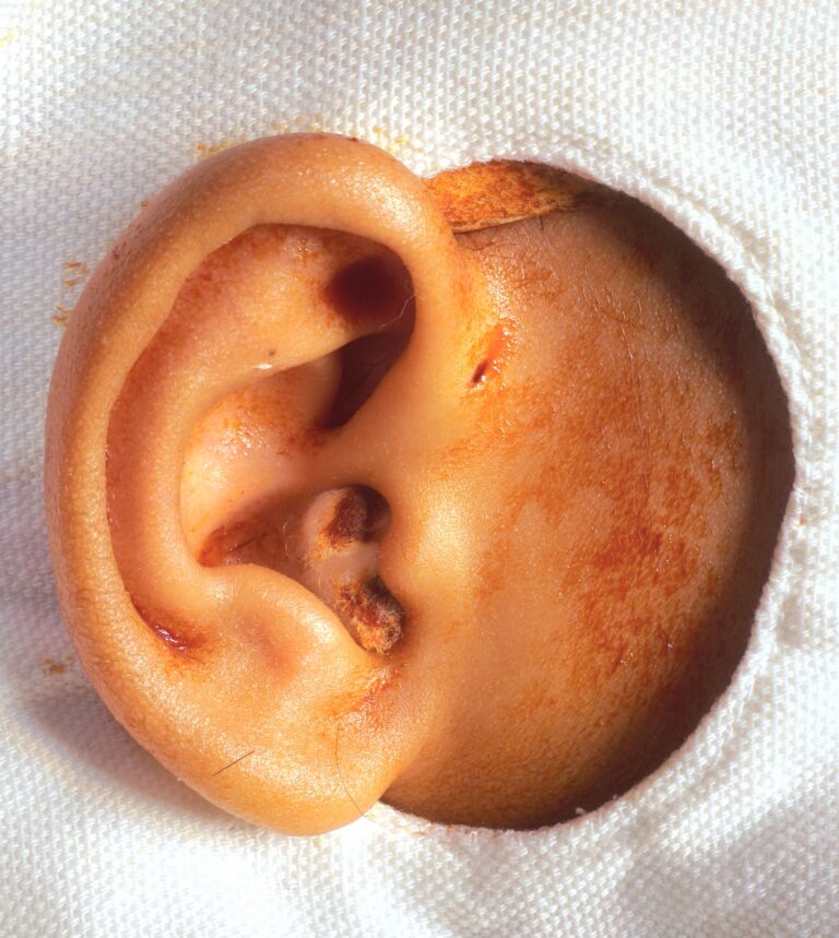HAVE YOU SEEN A HOLE IN FRONT OF YOUR EAR? - Dr. Ruth - Otolaryngology