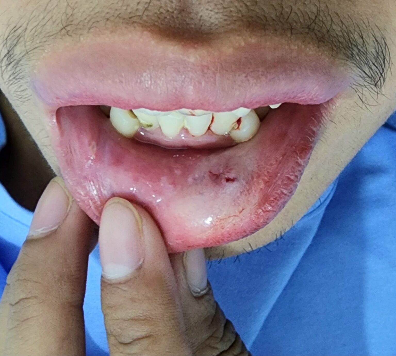 Lip Mucocele: Should It be Removed? - Dr. Ruth - Otolaryngology